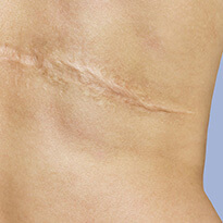 Tratament cicatrici laser | Clinica Derma Expert by Elōs