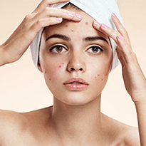 Tratament Acnee cu Laser VBeam | Derma Expert by Elōs