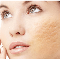 Tratament cicatrici laser | Clinica Derma Expert by Elōs