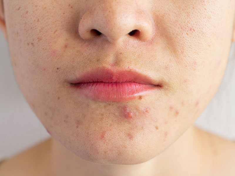 Totul despre Acnee: Cauze, Preventie si Tratament - Derma Expert by Elos